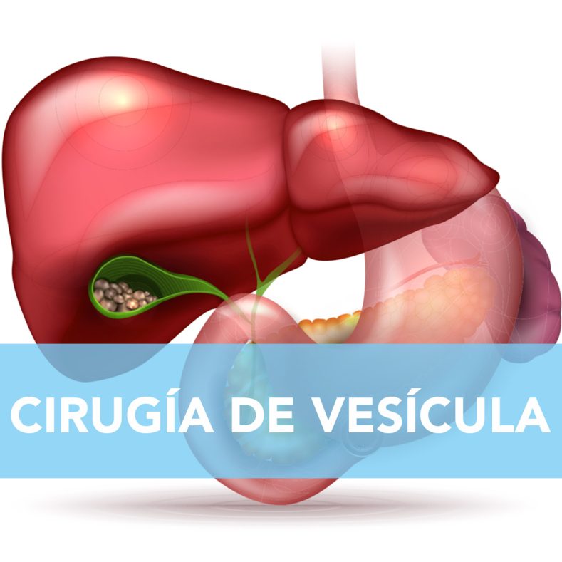 Cirugía de Vesícula – Dra. Glenda Herrera